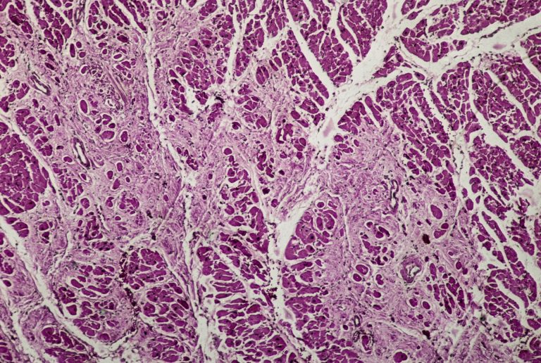 Cardiosclerosis | Medicinal Herbs Study Center